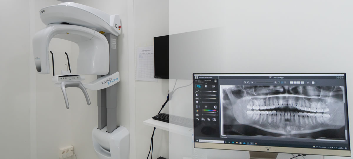 Radiología digital vs radiografía convencional - Clínica Dental ...